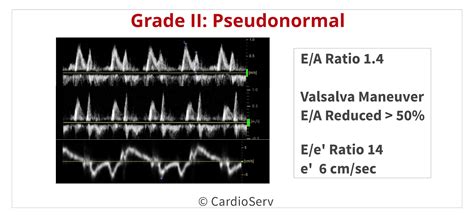 understanding the basics lv filling patterns cardioserv