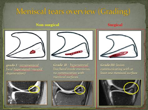 Figure 3 From The Amazing Axial Plan For Meniscal Tears Semantic Scholar