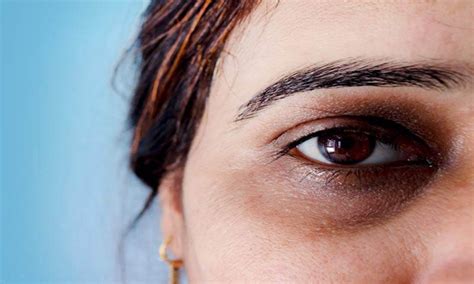 চোখের নিচের কালো দাগ দূর করার উপায়