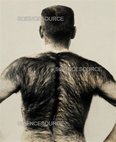 Man With Hairy Back 1916 Stock Image Science Source Images
