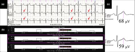 Representative Case Of T‐wave Alternans Twa Measurement Error Due To Download Scientific