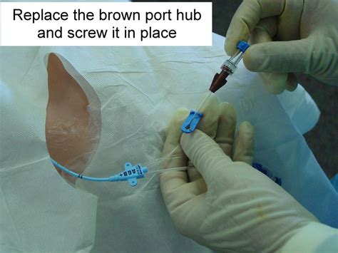 Clinical Notes Central Line Placement A Step By Step Procedure Guide With Photos