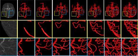 Comparisons Of Cerebrovascular Segmentation Results From Tof Mra Data