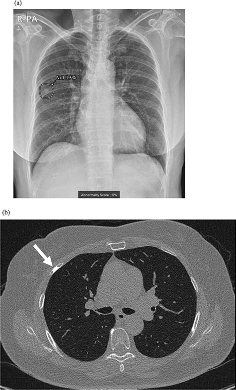 A False Positive Case Of A 71 Year Old Woman Who Underwent Initial Cxr Download Scientific