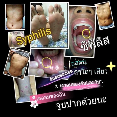 โรคซิฟิลิส คลินิกสุขภาพทางเพศและโรคติดต่อทางเพศสัมพันธ์