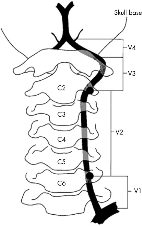 Imaging Of Vertebral Artery Stenosis A Systematic Review Journal Of