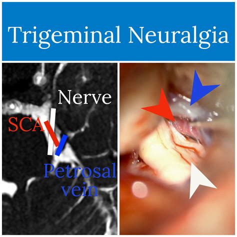 Trigeminal Neuralgia Trigeminal Neuralgia