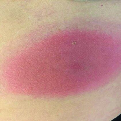 Erythema Migrans In A Patient With Lyme Disease At Initial