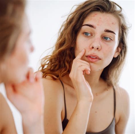 Retinol Purging Everything You Need To Know Per Dermatologists