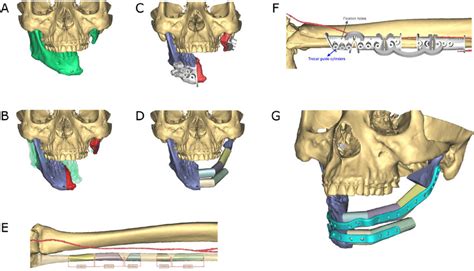 Secondary Mandible Reconstruction With A Double Barrel Fibula Bone Flap Download Scientific