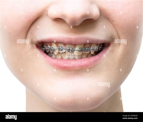 Front View Of Metal Dental Braces On Teeth Of Upper Jaw Of Girl Closeup