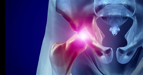 Femoroacetabular Impingement New Iberia La Orthopedic Surgery Wm
