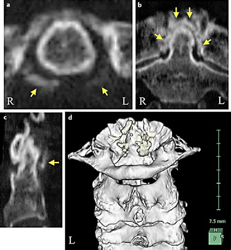 Cervical Ct Scans Around The Odontoid Process Dens A The Axial Image