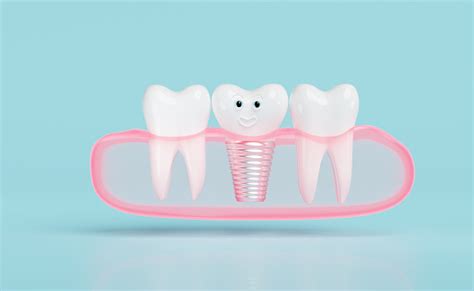 파란색 배경에 분리된 치과 임플란트가 있는 3d 잇몸 3d 렌더링 일러스트레이션 3차원 형태에 대한 스톡 사진 및 기타 이미지 3차원 형태 건강관리와 의술 건강한