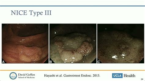 Assessment And Classification Of Large Colon Polyps Youtube