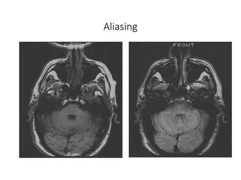 Mri Artifacts Introduction Classification Types Ppt