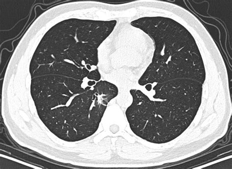 Chest Image Of A Covid 19 Pneumonia Patient With Patchy Consolidation