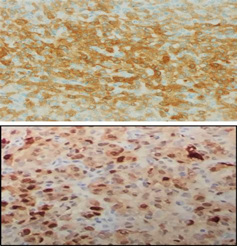 Neural Immunohistochemical Markers Like Neuron Specific Enolase Nse Download Scientific