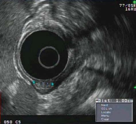Eus Of The Stomach Showing Invasion Of The Malignant Lesion Into The Download Scientific
