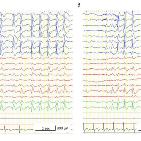 Scalp Electroencephalogram EEG At Years Of Age All EEGs Were Download Scientific Diagram