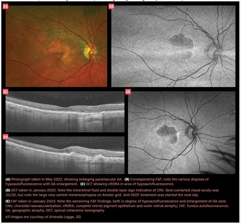 Keeping An Eye On Geographic Atrophy