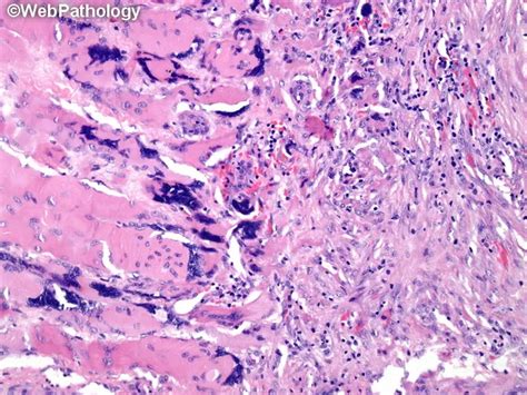 Nodular Fasciitis Intramuscular