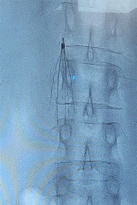 What Is An Ivc Filter