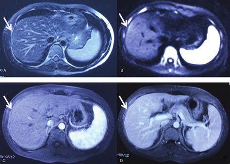 After The First Cycle Of Xelox Chemotherapy A Axial T2 Weighted And