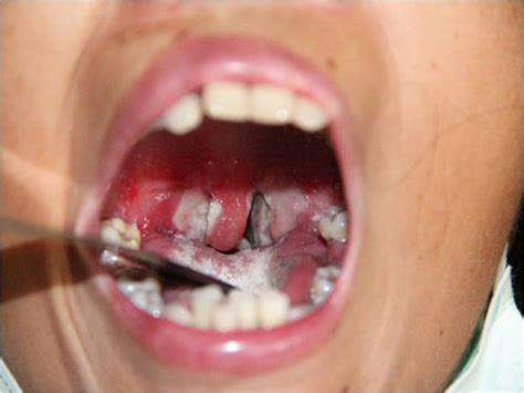 La Difterite Infezioni E Malattie Infettive