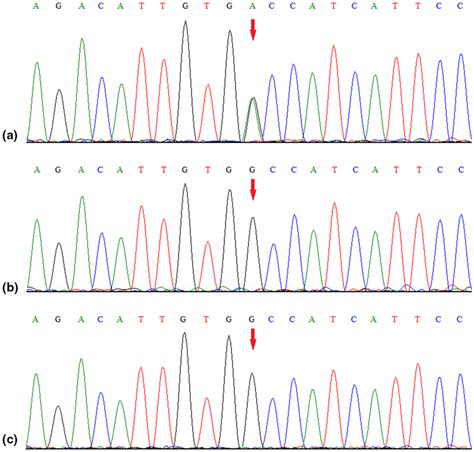 Sanger Sequencing Results For The Patient A And The Patients Father Download Scientific