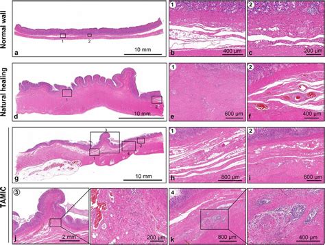 Granulation Tissue In The Submucosal Layer Upon The Defect Floor A