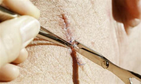 Suture Removal Times Explained By Medico Sutures