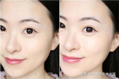 玻尿酸和除皱针的区别 知乎