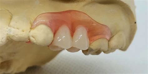 Nesbit Flexible Partial Denture Online Vida Smile Care