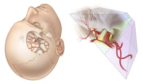 Pterional Craniotomy Cohen Collection Volumes The Neurosurgical Atlas