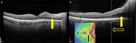 Combining Paracentral Acute Middle Maculopathy And Peripapillary Fluid