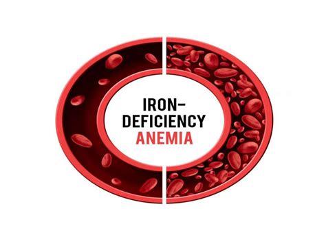 Medical Surgicalnursing Anemia Ppt Raafat Pptxpptx