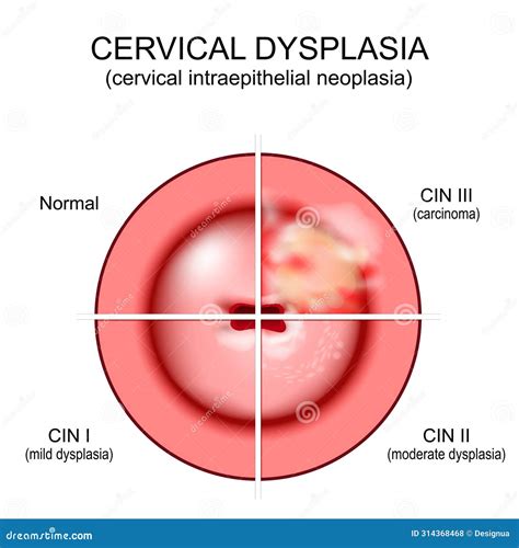 Cervical Dysplasia Close Up Of A Cervix Stock Vector Illustration Of