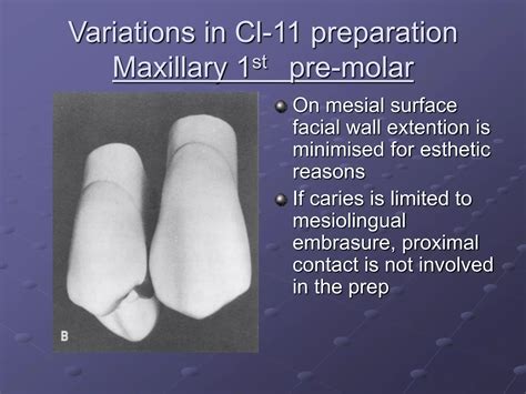 Class Ii Tooth Prep For Saf Ppt