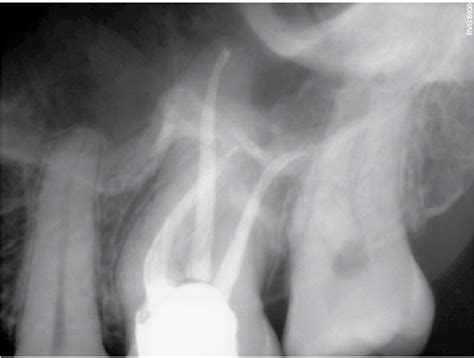 Postoperative Intraoral Digital Periapical Radiography Download Scientific Diagram
