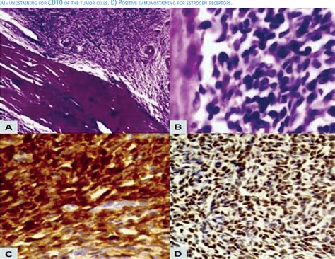 Low Grade Endometrial Stromal Sarcoma Sarcoma Del Estroma Endometrial De Bajo Grado Semantic