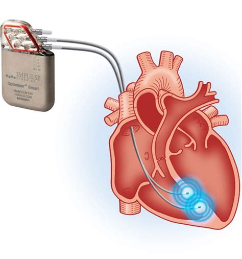 Next Generation Leadless Pacemakers And An Emerging Solution For Heart