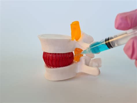 Model Of The Human Spine On In Doctor Uses A Syringe To Make An Injection Blockade Into A Hernia