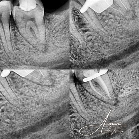 Dr Amani Al Khazraji On Linkedin Root Canal Treatment For A C Shaped