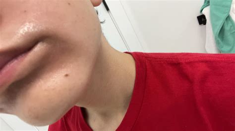 Hyperpigmentation On Side Of Lips Rskincarescience