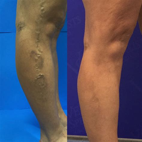 Before And After Vein Treatment Photos Vein Specialists Of The Carolinas
