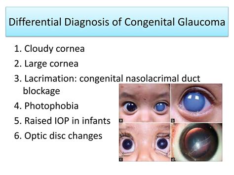Congenital Glaucoma Optometric Managmentppt