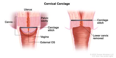 Cerclage Of Cervix During Pregnancy Direct Image Of The Cervical