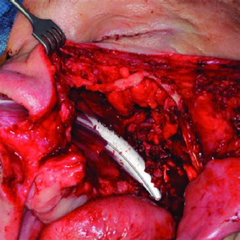 Defect After Maxillectomy Download Scientific Diagram