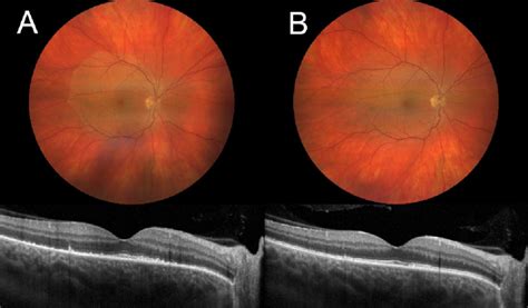 Acute Syphilitic Posterior Placoid Chorioretinitis A Is Represented Download Scientific